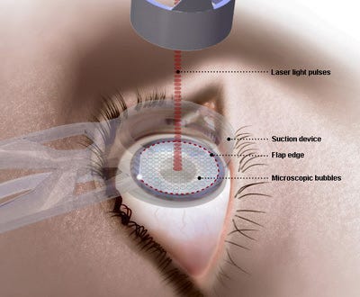 How safe is LASIK procedure?. LASIK is one of the safest procedures ...