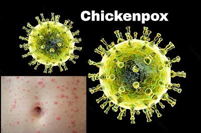 Looking for a chickenpox treatment? Here are five symptoms to look out ...