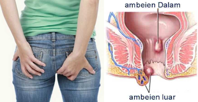 cara mengempeskan benjolan pada wasir yang mudah kambuh | by Fitria Ningsen | Medium