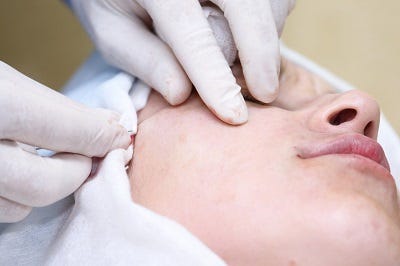 Vampire Facelift: Everything You Need to Know about This Procedure | by ...