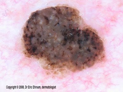 How can AI detect skin cancer with your smartphone | by Medical AI ...