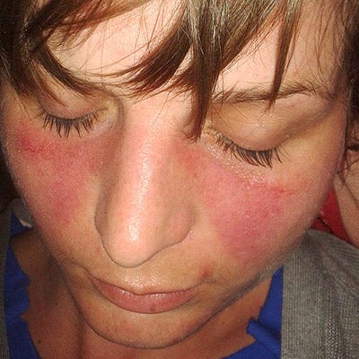 Differences Between Rheumatoid Arthritis And Systemic Lupus ...