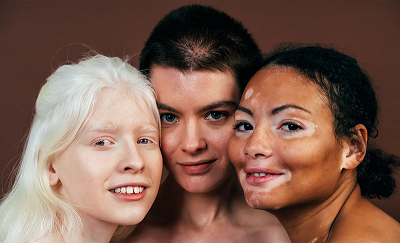 Celebrating Diversity: Famous Individuals Embracing Vitiligo | by Mohit ...