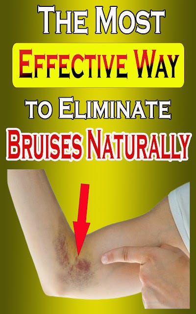 The Most Effective Way to Eliminate Bruises Naturally - wellnessmgz4 ...