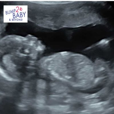 Early Gender Scan by Bump 2 Baby Scans: Get Quick Results | by ...