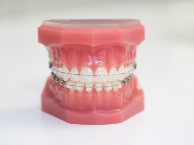 Clear Braces Scarborough. If you’re looking for a way to… | by ...