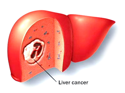 What are the symptoms of liver cancer? | by Globus Hospital ...