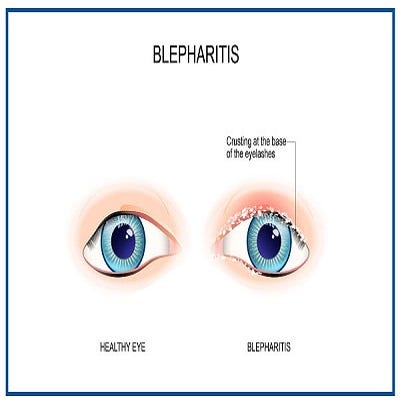 Blepharitis Treatment Doctor | Drlunaxu.com - Insight Ophthalmology ...
