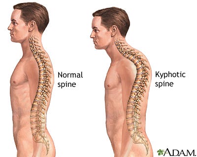 Developing a Decision Tree Algorithm in Python for Predicting a Kyphosis After a Corrective ...