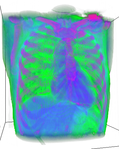 How to easily train a 3D U-Net or any other model for lung cancer segmentation. | by Aleksey ...