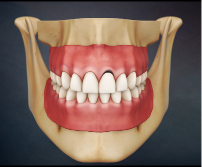 Get a Perfect Smile With All Ceramic Bridge | by Daniel Brown | Medium