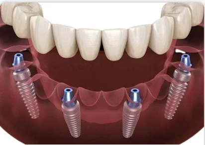 Experience the Latest Technology of Conventional Dentures in Las Vegas ...