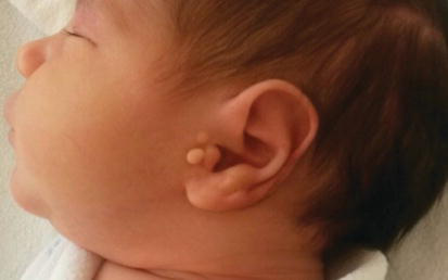 Preauricular Removal: Enhancing Facial Symmetry and Aesthetics | by ...