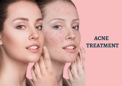 Acne Scar Treatment. Introduction | by UKS Derma | May, 2024 | Medium
