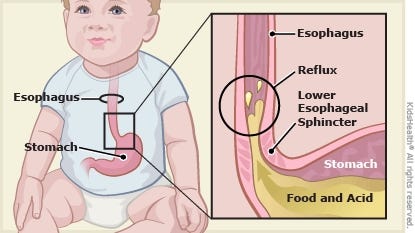 DEFINITION Infant reflux | by Jean B | Oct, 2024 | Medium