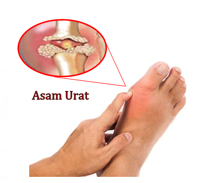 Ramuan Tradisional Penurun Asam Urat Ampuh | by Apotik Herbal | Medium