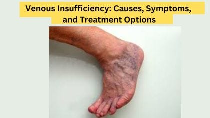 Venous Insufficiency: Causes, Symptoms, and Treatment Options | by ...