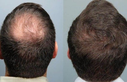 Is Frontal Fibrosing Alopecia (FFA) The Reason For Your Hair Loss? | by ...