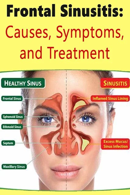 Frontal Sinusitis: Causes, Symptoms, and Treatment - Mary odonnell - Medium