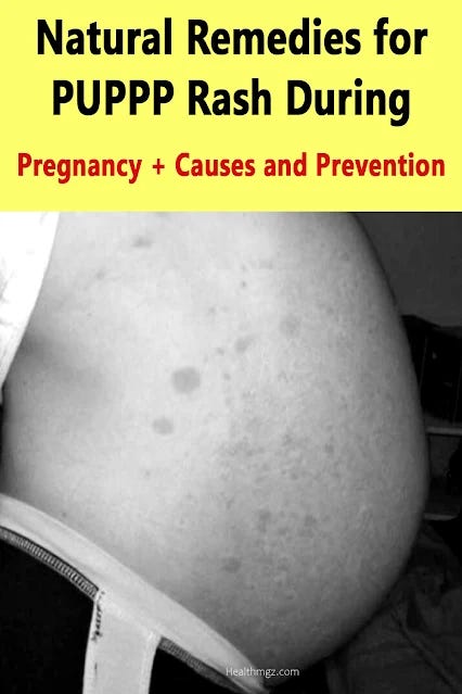 Natural Remedies For Puppp Rash During Pregnancy Causes And Prevention