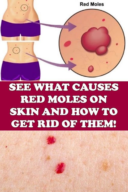 What Do The Red Moles On The Body Mean? - wellnessmgz4 - Medium