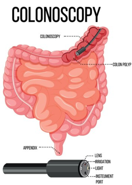 Where is the best colonoscopy in India? | by Dr. Sawan Bopanna | Apr ...