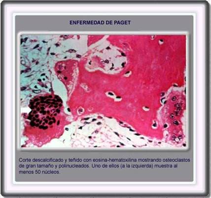 ENFERMEDAD DE PAGET. La enfermedad de Paget es un trastorno… | by KEVIN ...