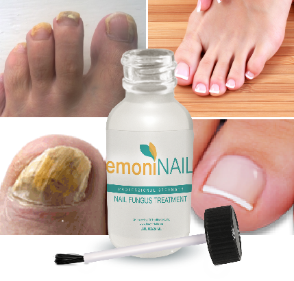 EmoniNail — Nail Fungus Ingredients, Price, Uses, Results And Benefits ...