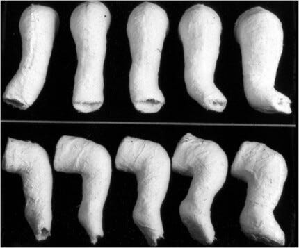 How to use the clubfoot brace? - Thomas Sharp - Medium