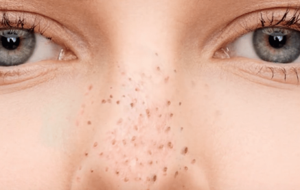 How do remove blackheads naturally? | by Nizamul Hoq chowdhury | Medium