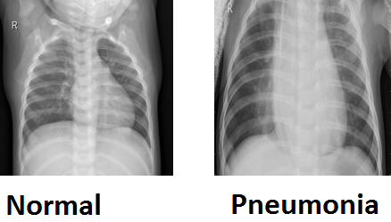 Logistic Regression and CNN with PyTorch: Pneumonia Detection for ...