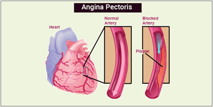 Angina Pectoris | Angina Pain Causes, Symptoms & Treatment ...