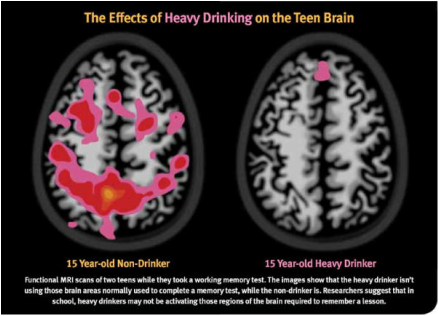 The Effects of Alcohol On the Teenage Brain | by Greg Blankenship | Medium