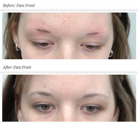 What is Best Treatment of Eyebrow Hair Loss | by Best Hair Transplant ...