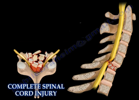 Sacral Sparing. Sacral sparing tests can be used to… | by Nabil ...