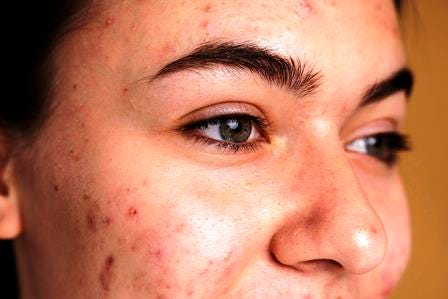 3 Best Scar treatment for face Medically Approved - shehzad mustafa ...