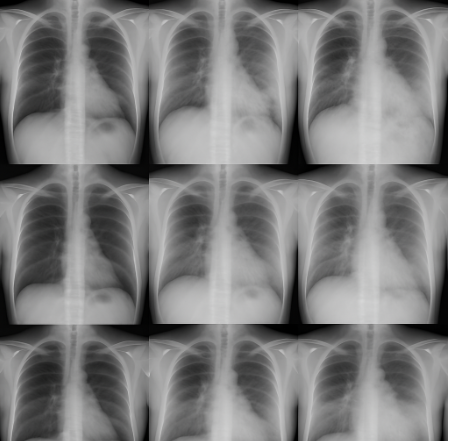 Pneumonia Prediction with X-ray Images Using Snowflake Cortex ...