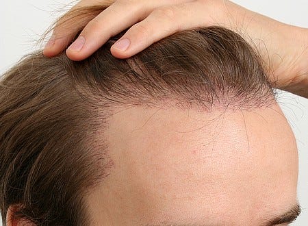 Know the Difference between Mature Hairline and Male Pattern Baldness ...