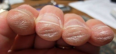 Finger Soreness. Finger soreness, is one of the major… | by Siddhant's ...