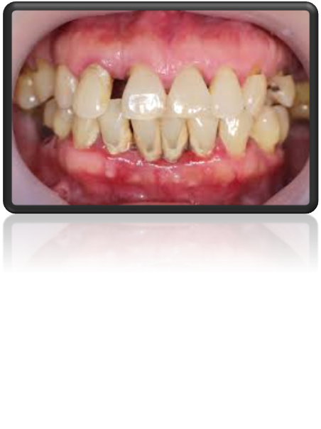 Detection of Periodontitis with AI | by Rashi Agrawal | Medium