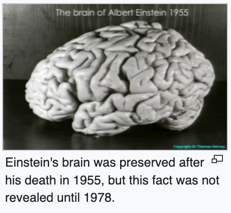 Albert Einstein Brain Vs Normal Brain