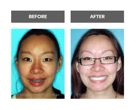 Get Your Teeth Straighten and Braces from the Orthodontist in Sydney ...