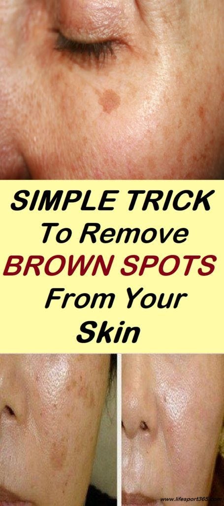 SIMPLE TRICK TO REMOVE BROWN SPOTS FROM YOUR SKIN - Carol Terry - Medium