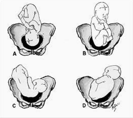 Datos Interesantes sobre la Distocia Fetal en la Labor de Parto | by ...