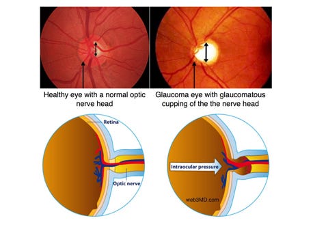 What causes glaucoma?. Glaucoma is typically caused by… | by Smart ...