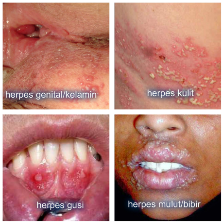 Cara mengobati herpes simplex. Cara mengobati herpes simplex | by ...