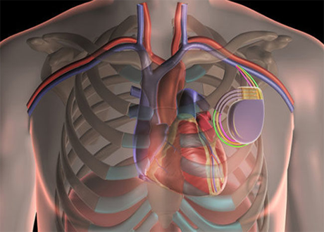 ICD implantation in Delhi. - Dr Vivek Kumar - Medium