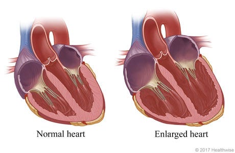 Enlarged heart (Cardiomegaly): Causes, Symptoms | by Arvisaravanan | Medium