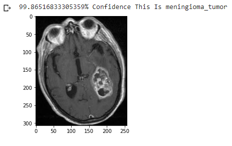 Brain Tumor Segmentation Using Deep Learning | by Sayanb | Medium