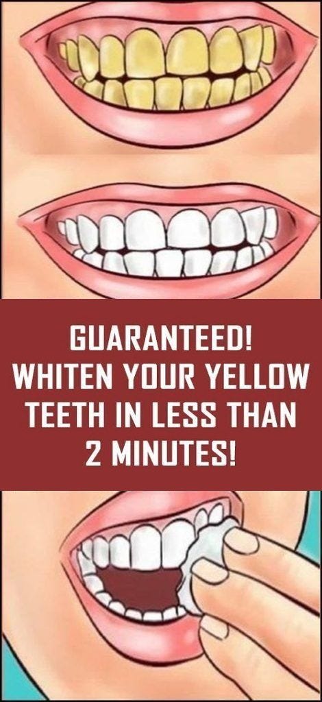 GUARANTEED! Whiten Your Yellow Teeth In Less Than 2 Minutes! - Hannah ...